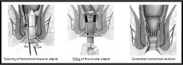 Hemorrhoidectomy General Surgery